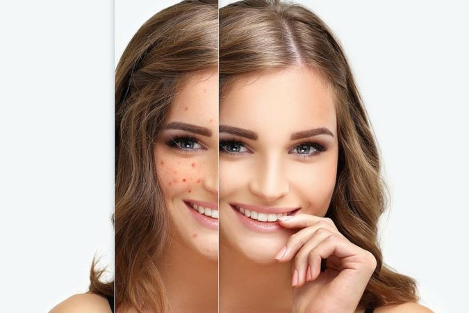 How to remove freckles naturally at home? - BeautyLifeChoice